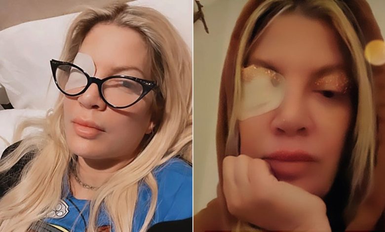 Tori Spelling gets eye ulcer after wearing contact lenses for 20 days ... Tori Spelling gets eye ulcer after wearing contact lenses for 20 days ...